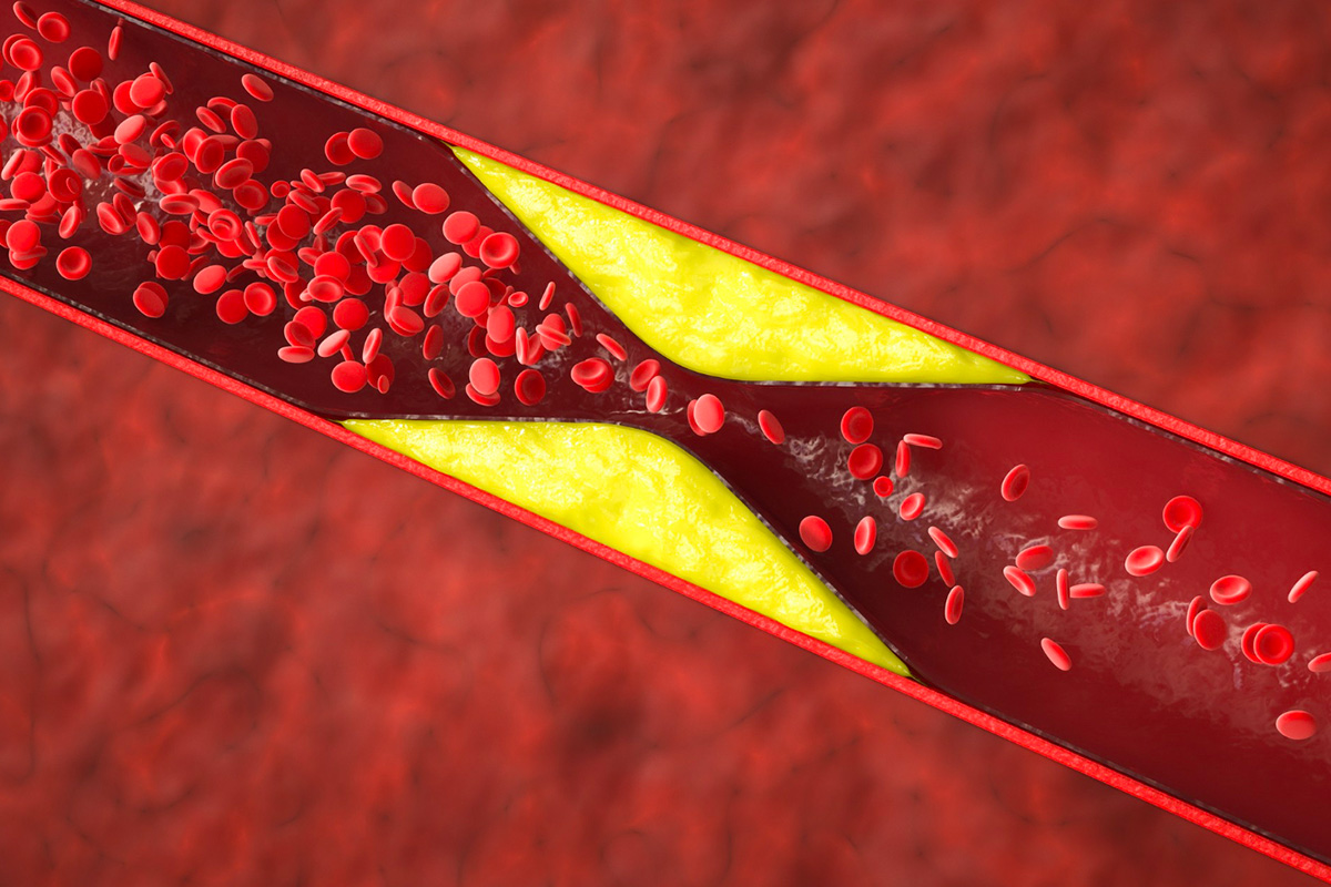 Le Cholestérol : qu'est-ce que c'est