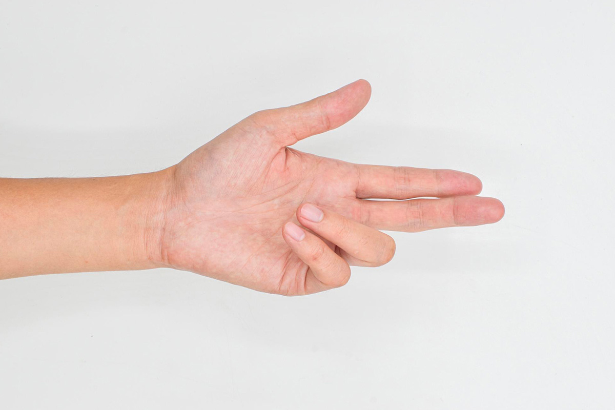 La maladie de Dupuytren : causes, symptômes et traitements